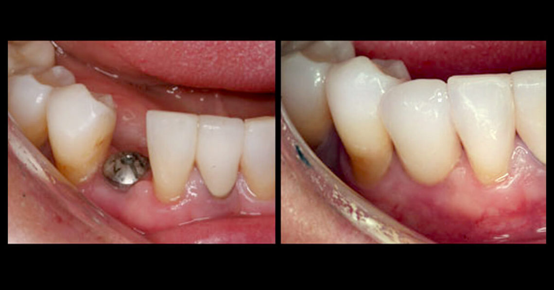 Implant Crowns – Victoria Dental Group